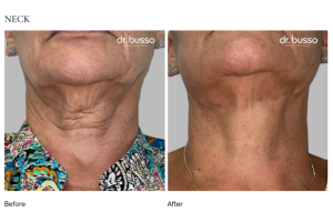 PDO Thread Lift: Stunning Before and After Transformations