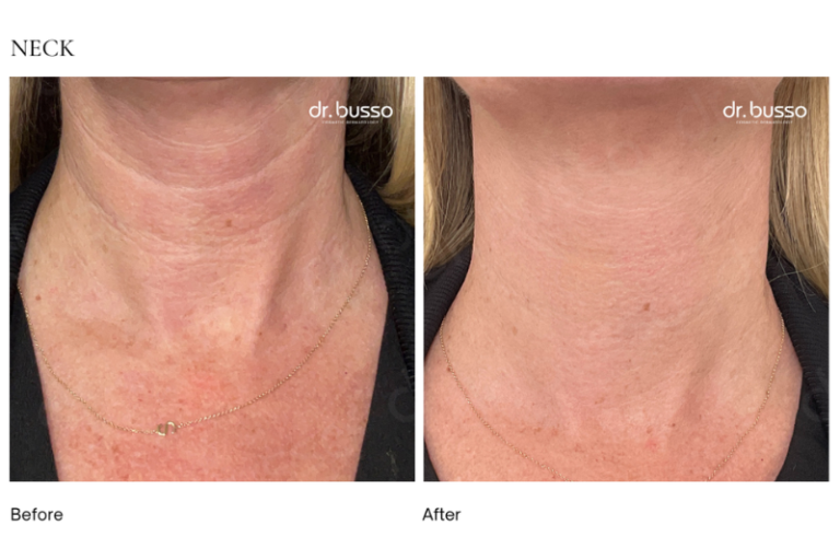 Before and After Photo Gallery – Skinvive | Mariano Busso, MD, PA